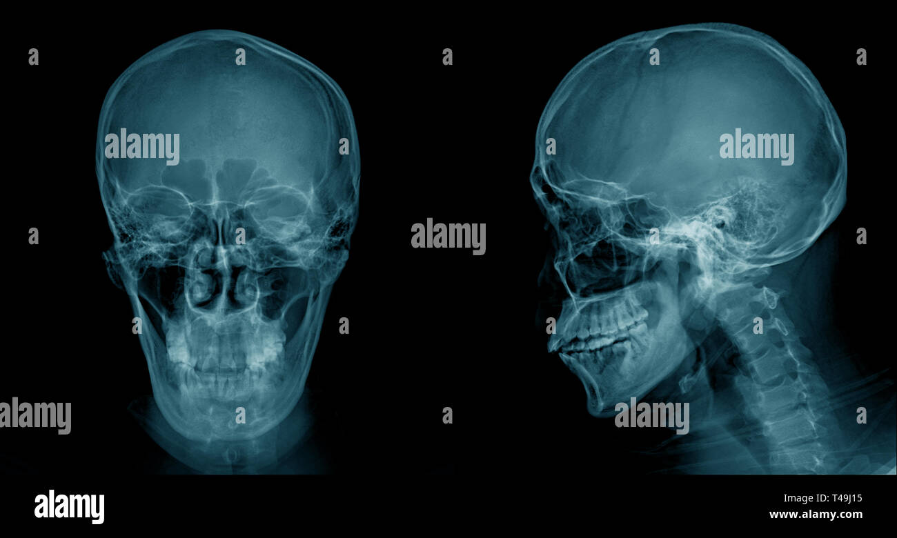 X Ray Head Injury Do You Have A Concussion? | Concussion.org