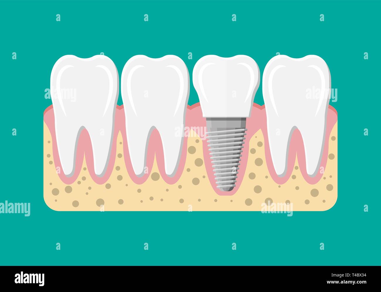 Tooth restoration. Dental implant. Dental prostheses. Artificial teeth ...