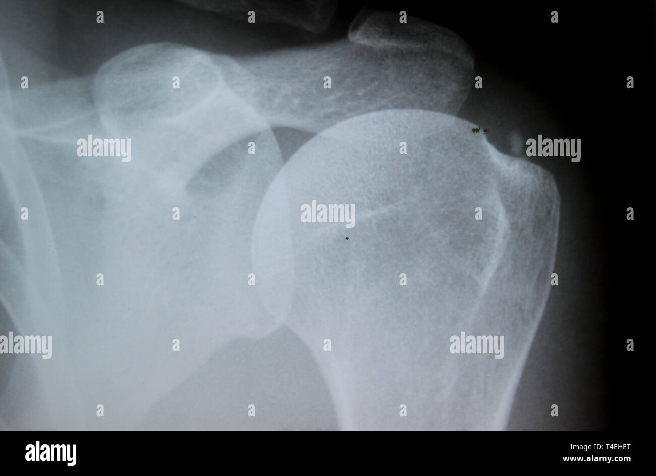 Normal shoulder x ray hi-res stock photography and images - Alamy