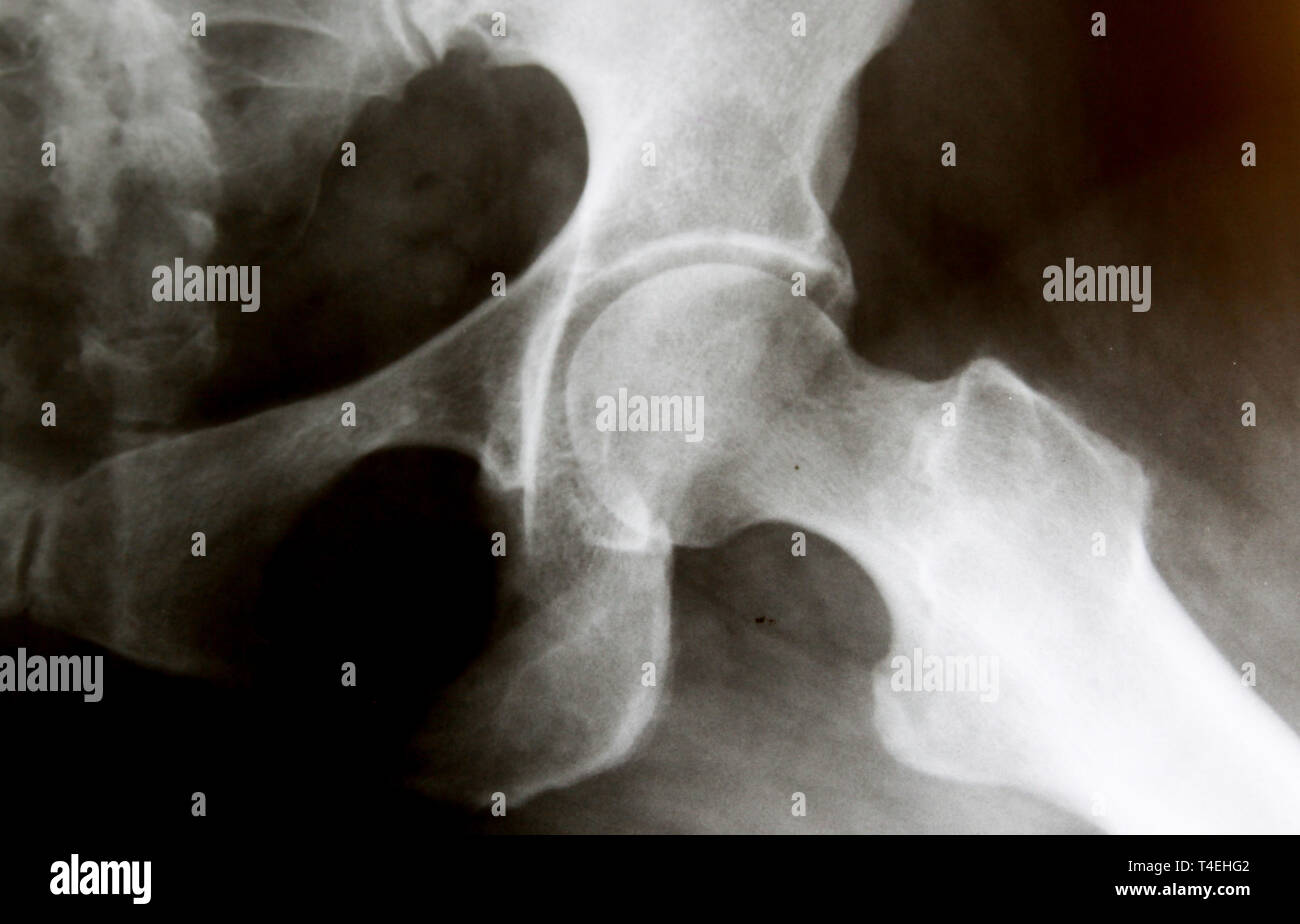 X-Ray image of regular hip joint Stock Photo - Alamy