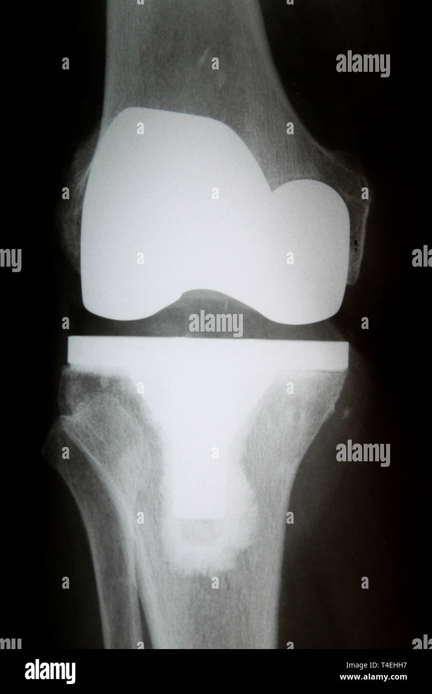 Normal Knee X Ray High Resolution Stock Photography and Images - Alamy