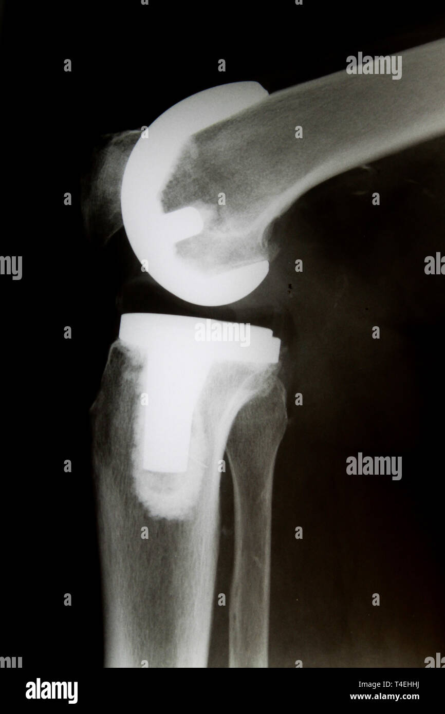 X-Ray image of knee with complete artificial joint replacement ...