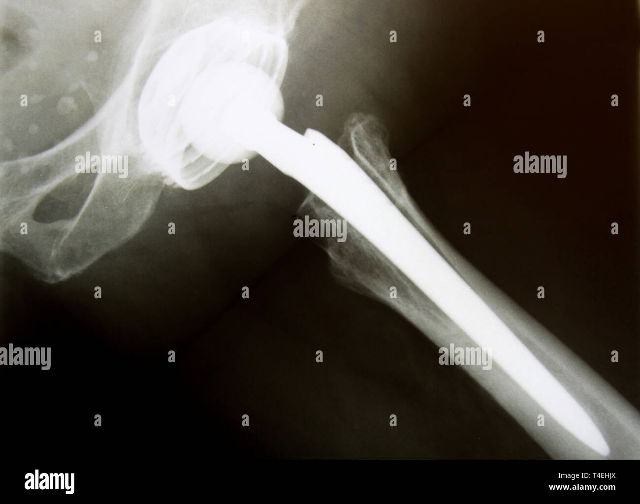 X-Ray image of hip with implanted artificial joint replacement ...