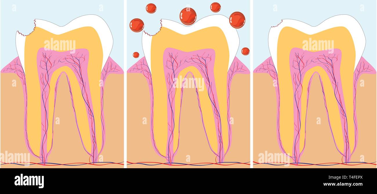 Three phase of caries treatment, vector illustration Stock Vector Image ...