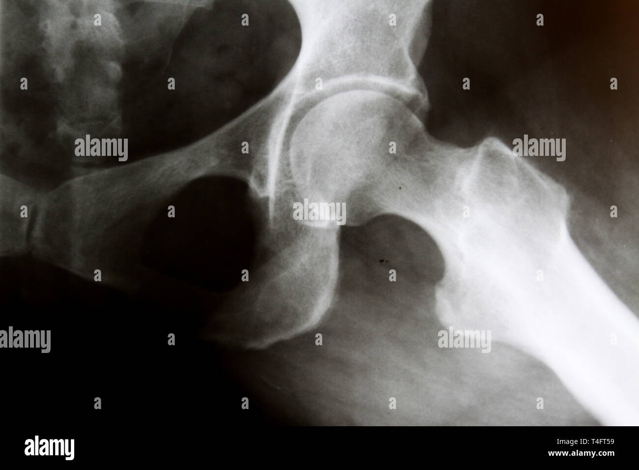 X-Ray image of regular hip joint Stock Photo - Alamy