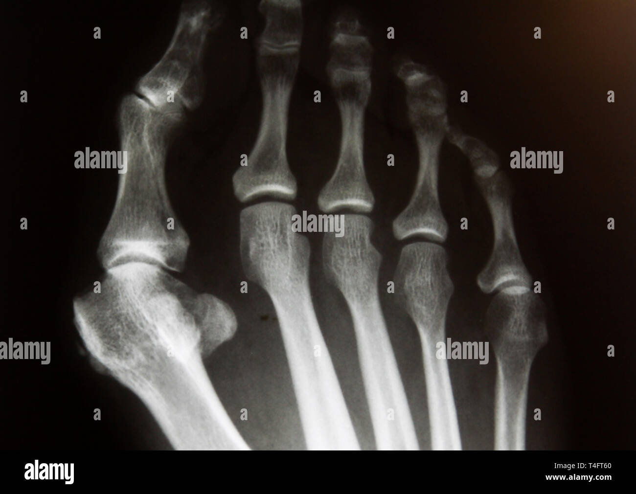 Valgus deformity hi-res stock photography and images - Alamy