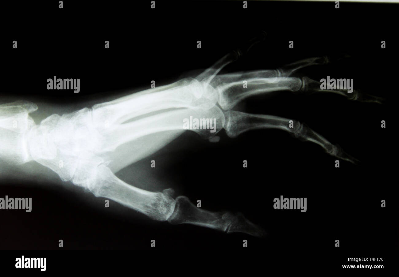 X-ray image of healthy normal human hand Stock Photo - Alamy
