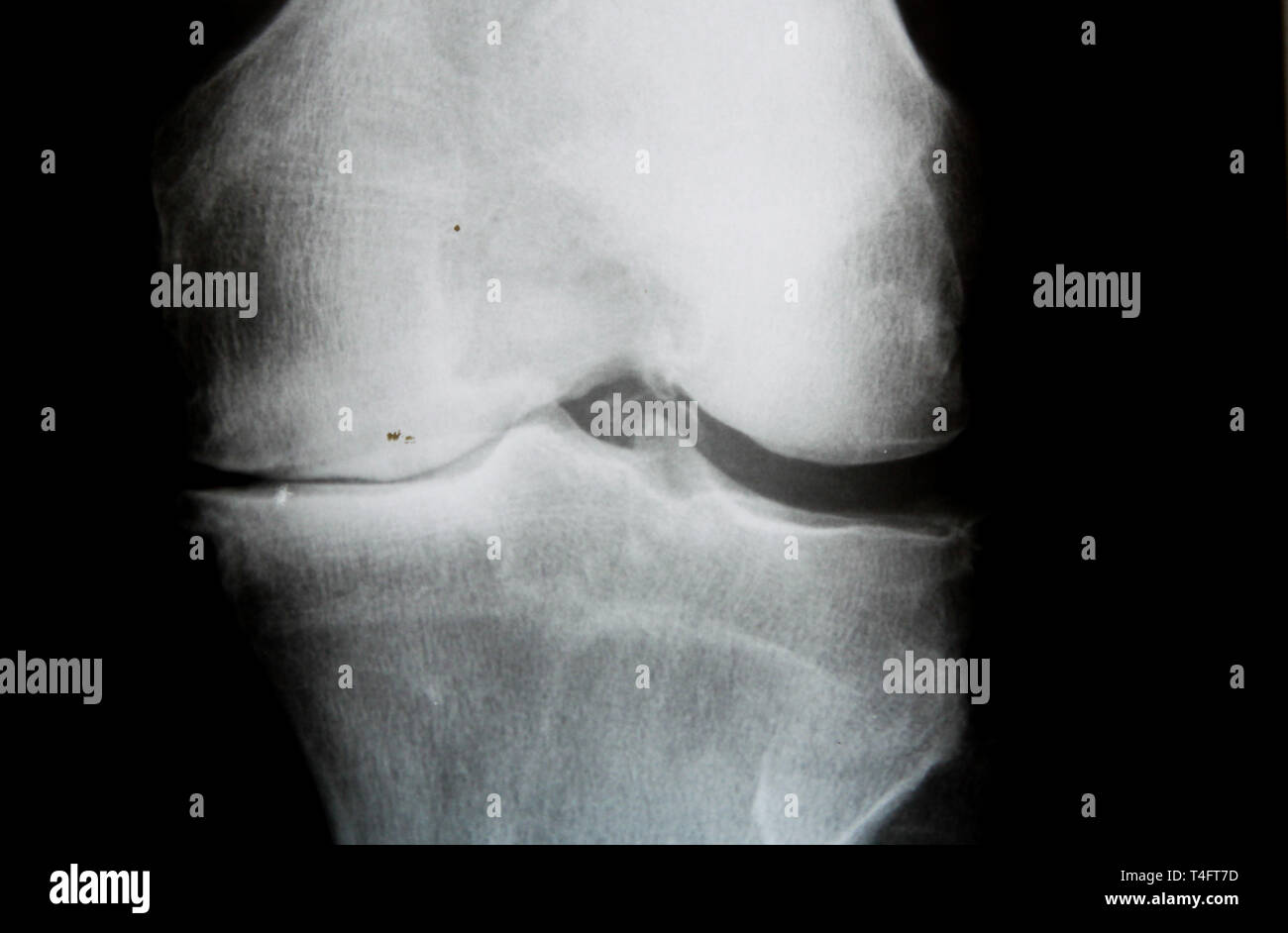Normal knee x ray hi-res stock photography and images - Alamy