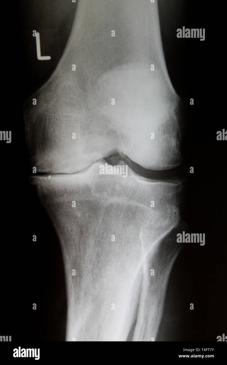 Normal knee x ray hi-res stock photography and images - Alamy