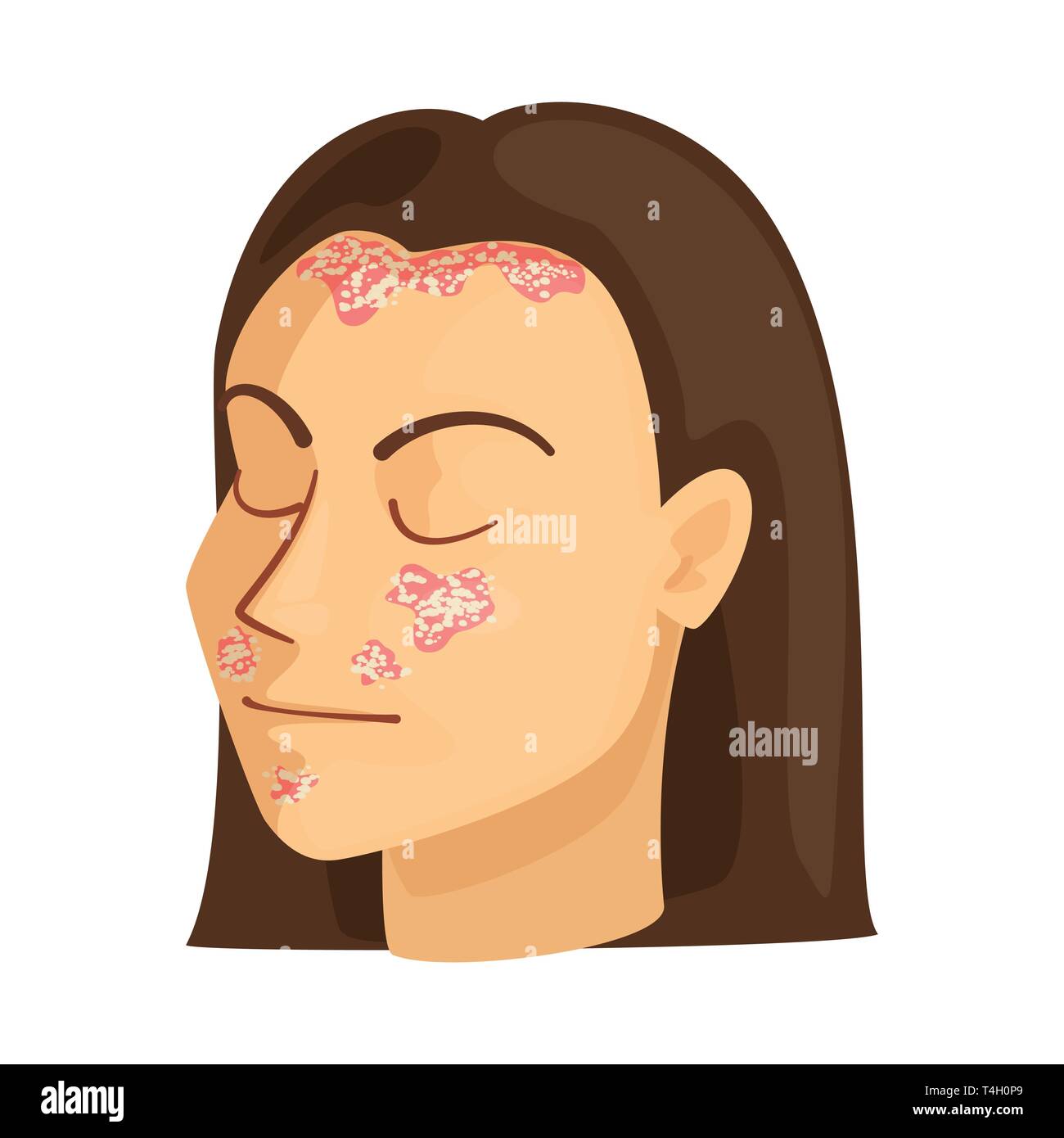 Vector illustration of psoriasis and skin symbol. Set of psoriasis and ...