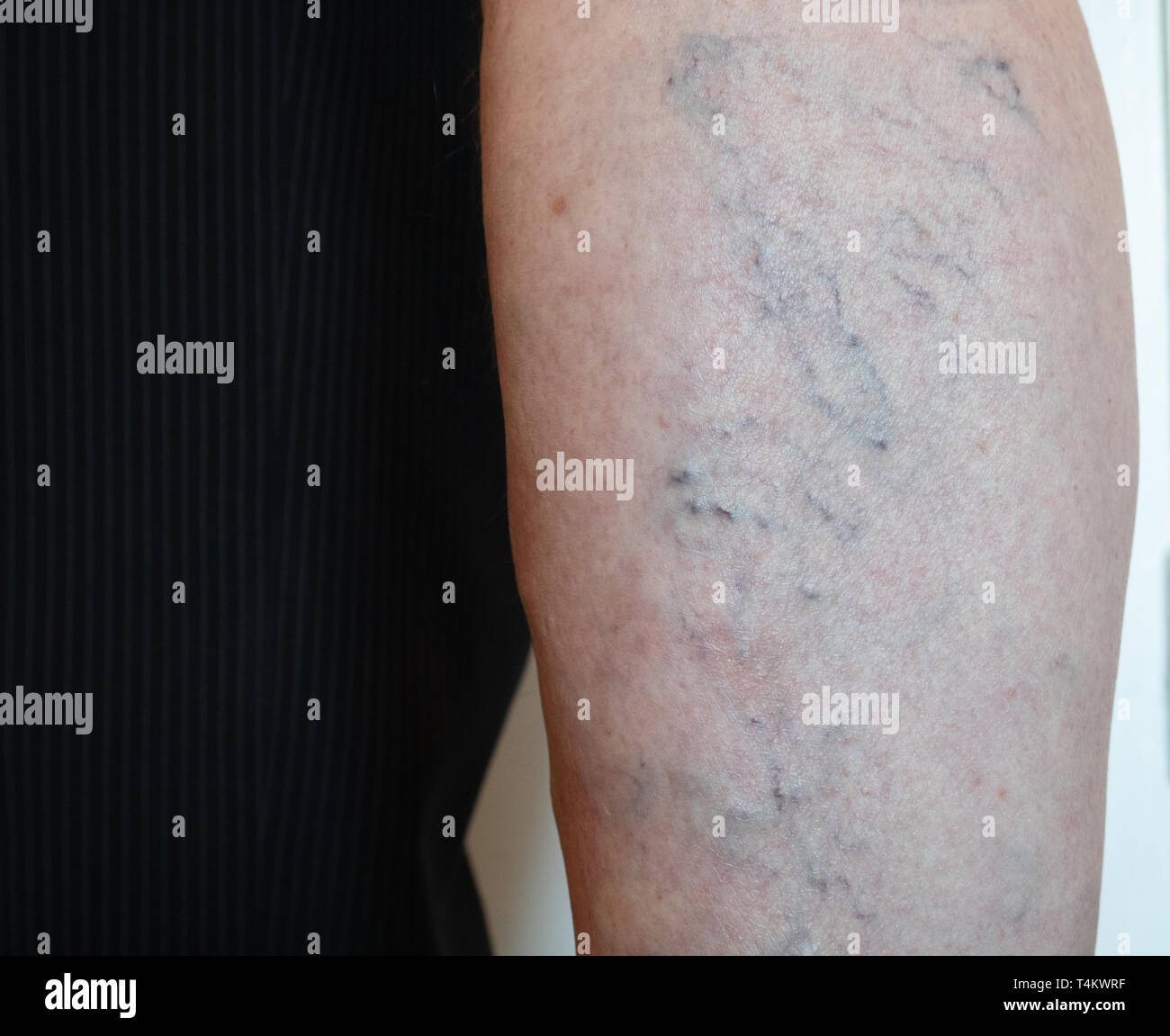 closeup of old man's leg with capillary mesh which cause varicose veins ...