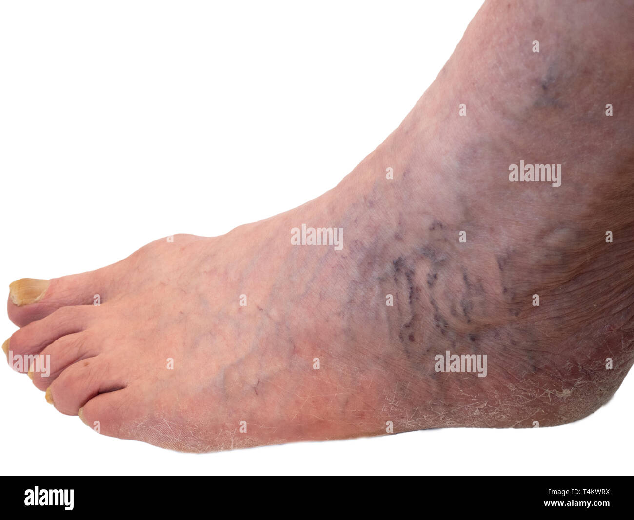 senior old man leg with diseases like fungus on nails and capillary ...