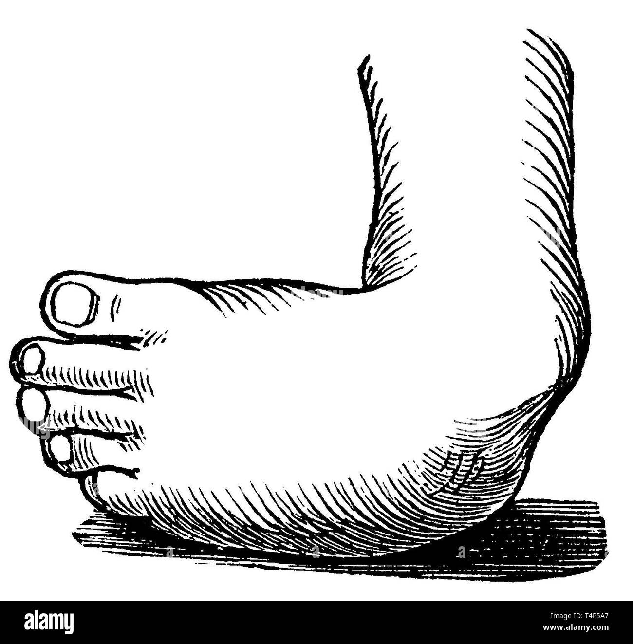 club foot, J.D. 1887 Stock Photo - Alamy