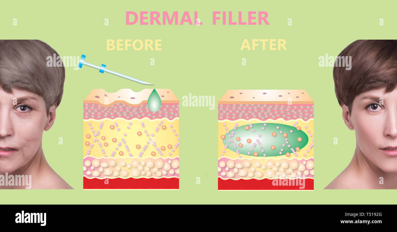 Dermal hi-res stock photography and images - Alamy