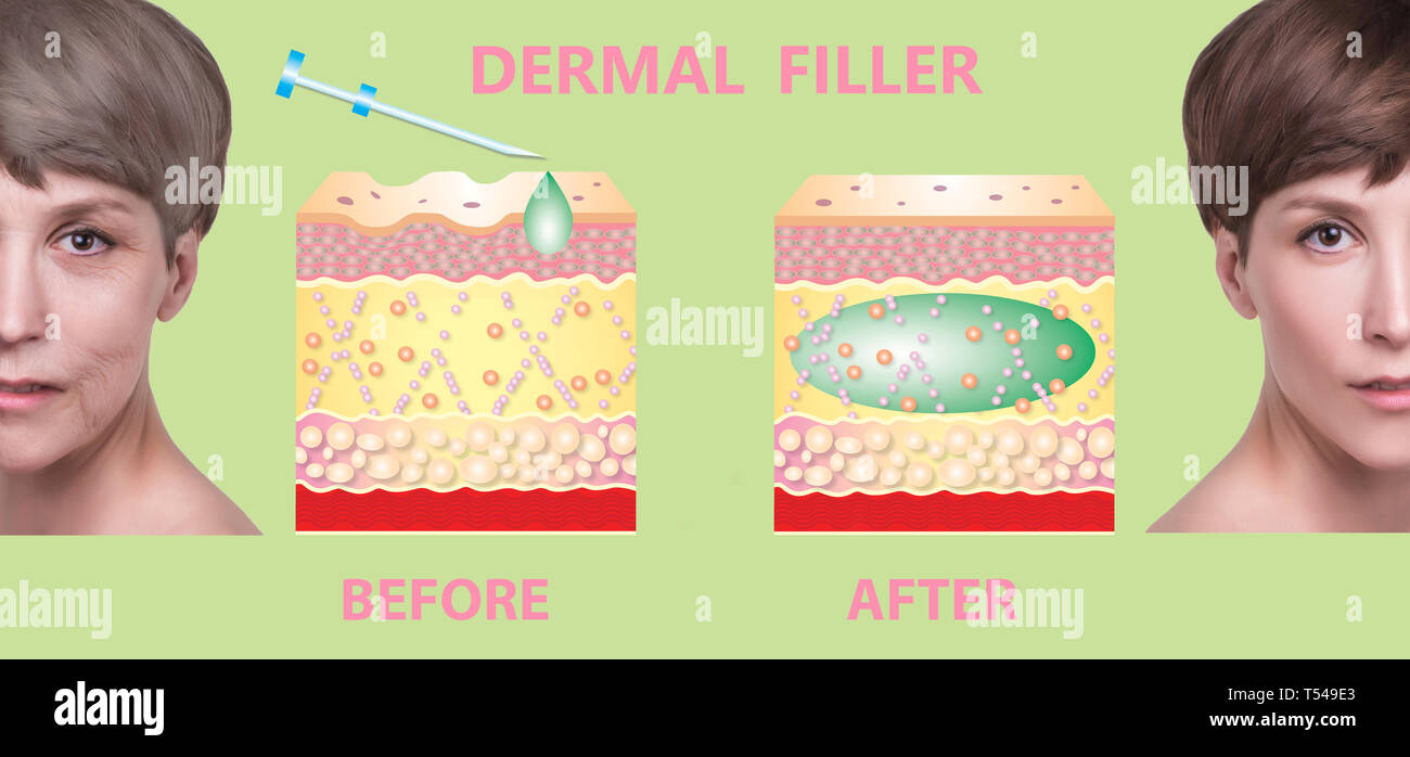 Cosmetic filler or dermal fillers Stock Photo - Alamy
