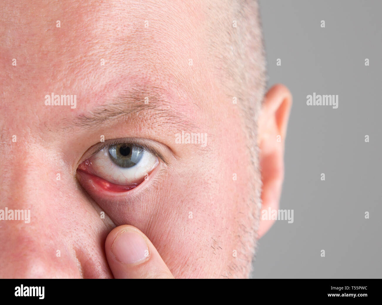 Stye in eye hi-res stock photography and images - Alamy