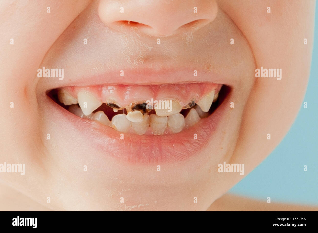 Rotten teeth baby hi-res stock photography and images - Alamy