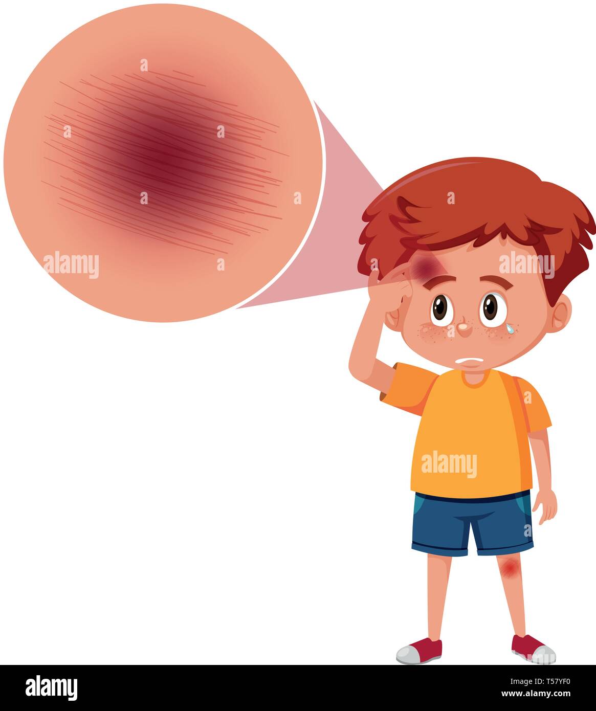 Boy with scab Stock Vector Images - Alamy