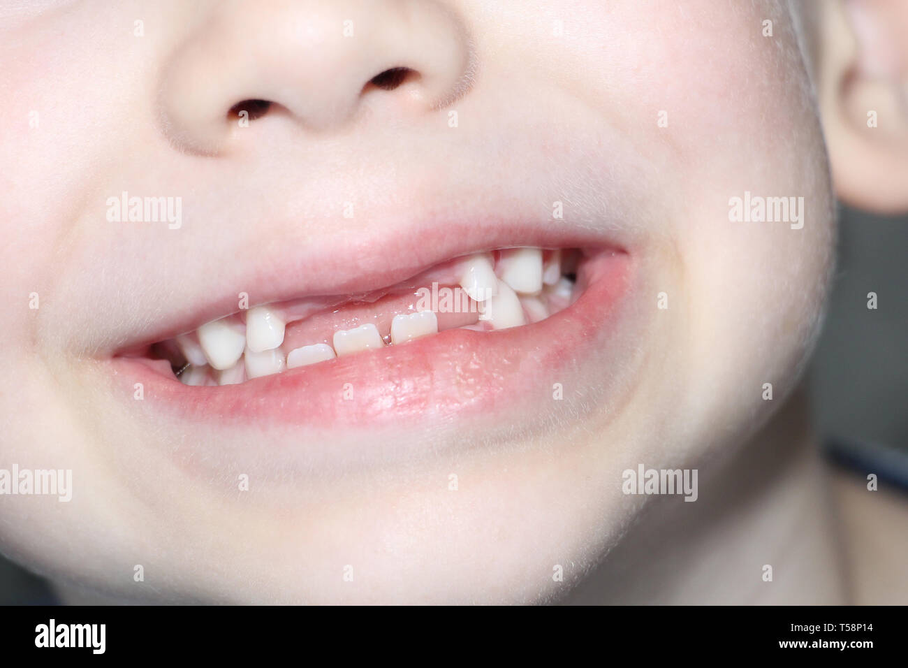 Milk teeth hi-res stock photography and images - Alamy