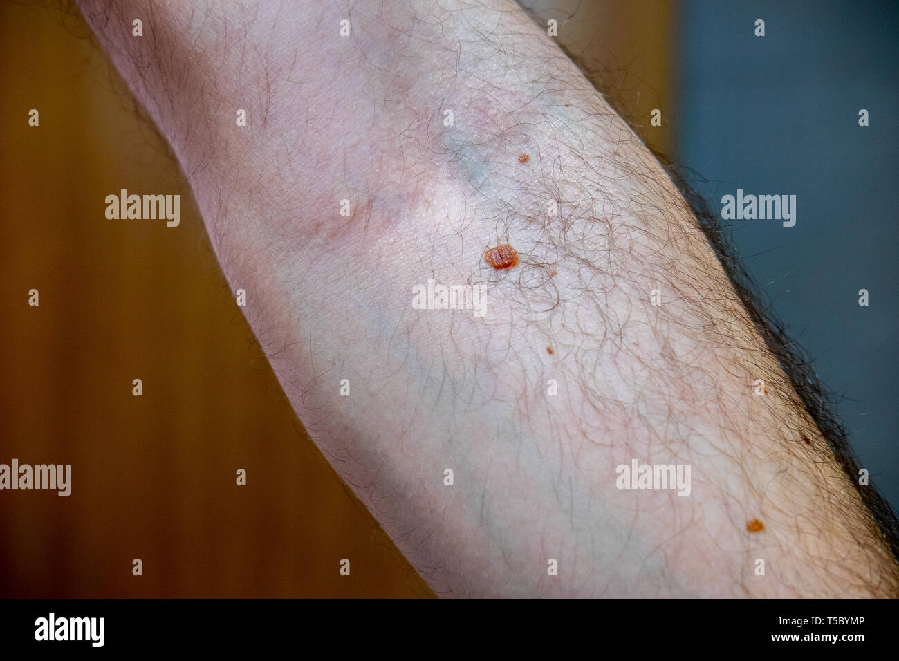A melanocytic nevus also known as nevocytic , nevus-cell and commonly ...
