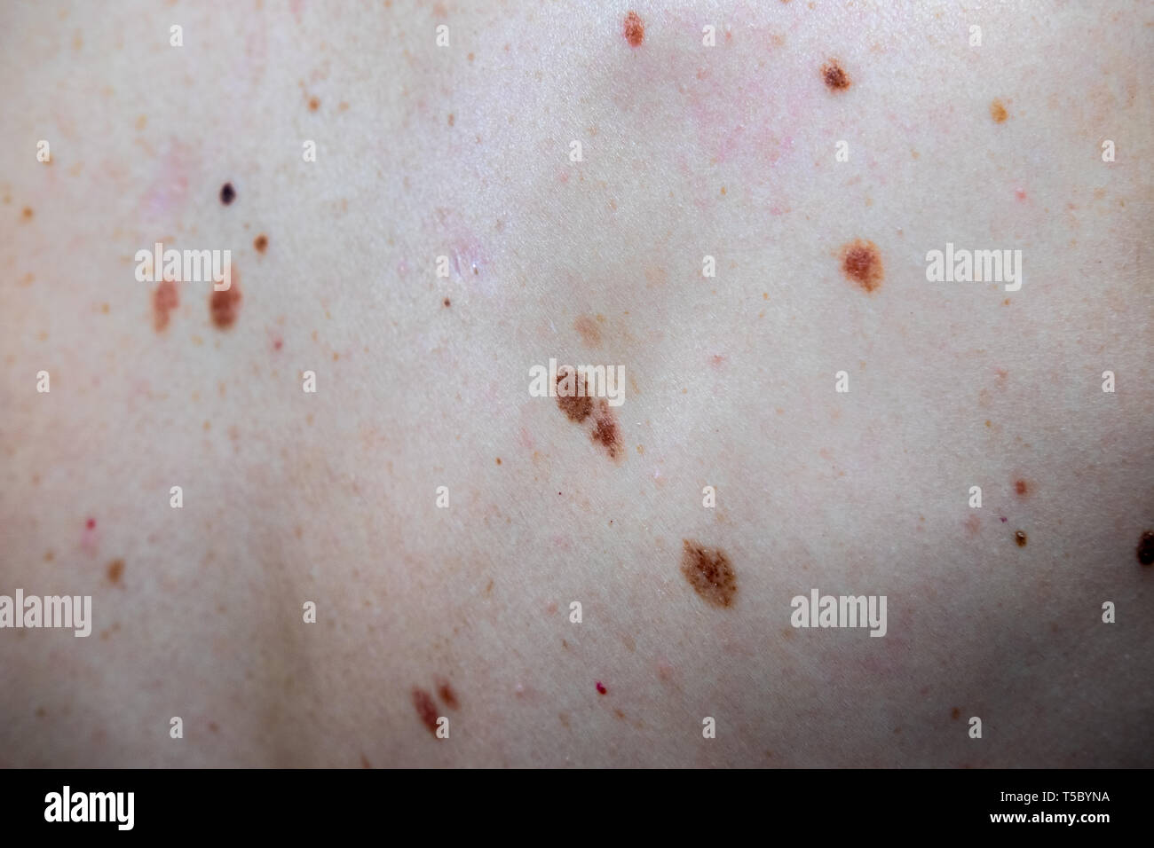 A melanocytic nevus also known as nevocytic , nevus-cell and commonly ...