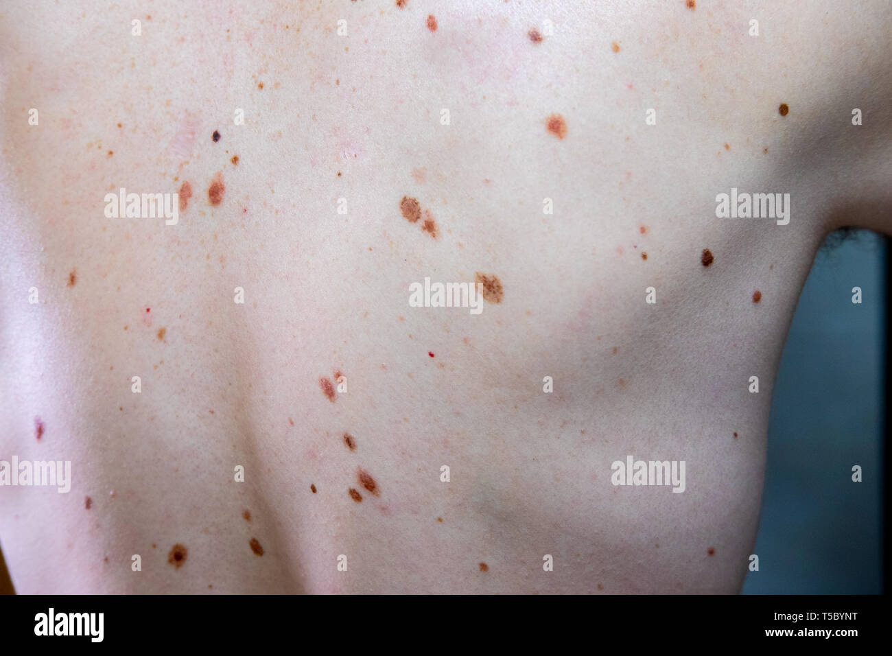 A melanocytic nevus also known as nevocytic , nevus-cell and commonly ...