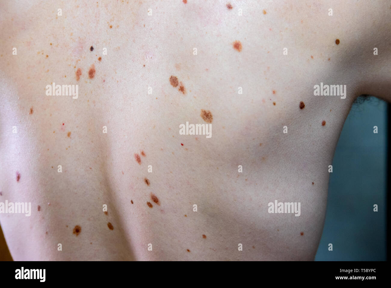 A melanocytic nevus also known as nevocytic , nevus-cell and commonly ...