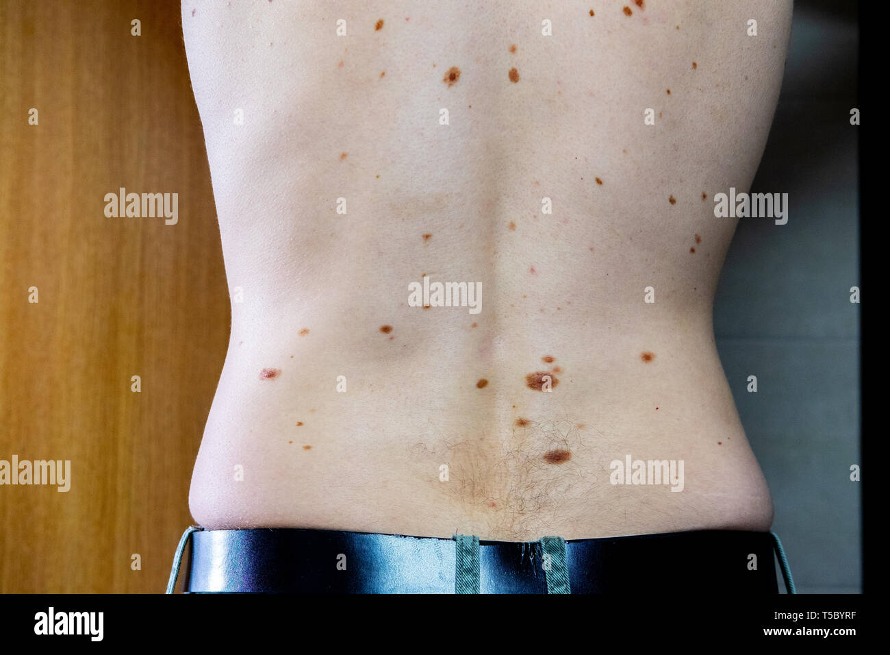 A melanocytic nevus also known as nevocytic , nevus-cell and commonly ...