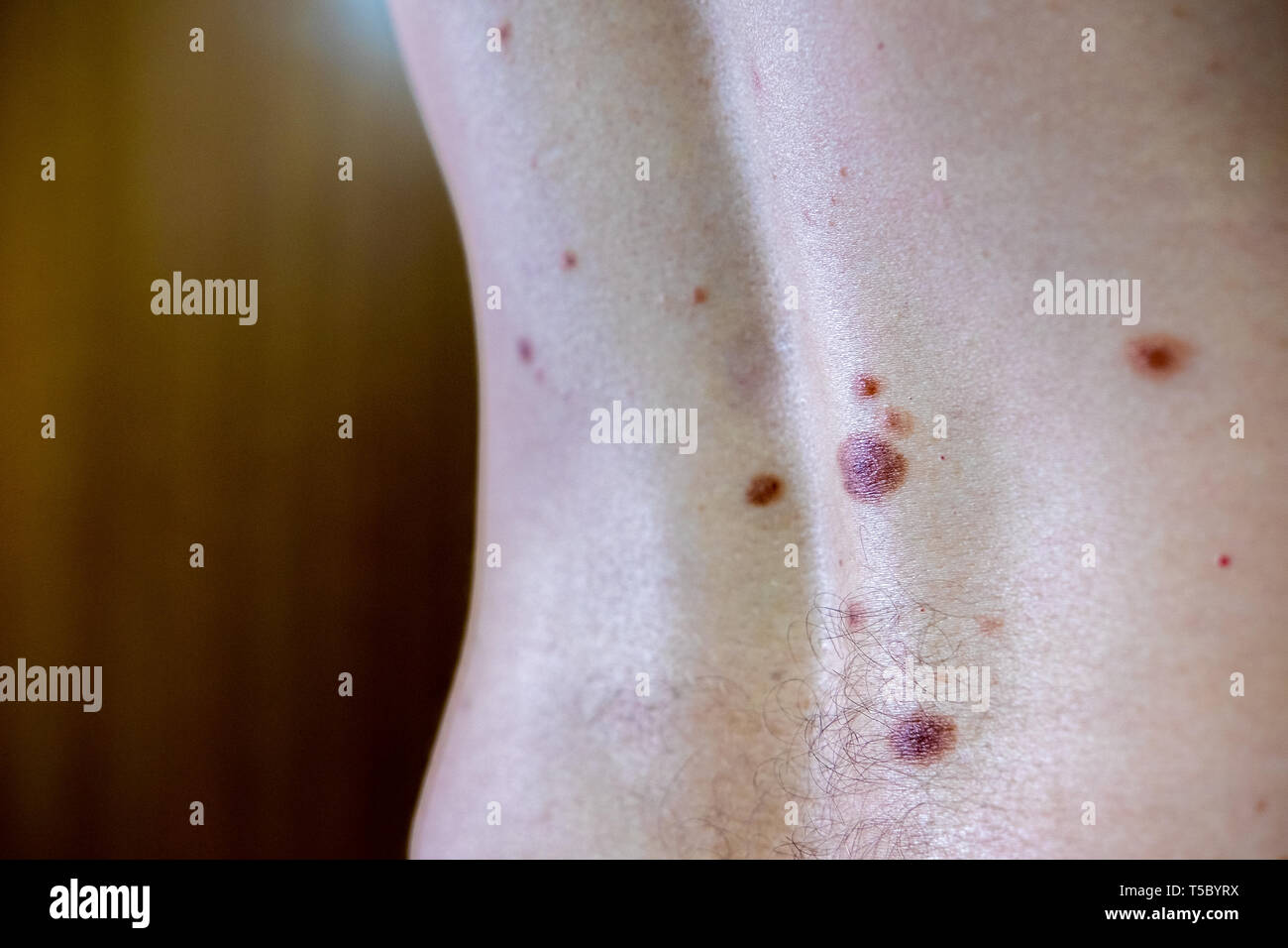 A melanocytic nevus also known as nevocytic , nevus-cell and commonly ...