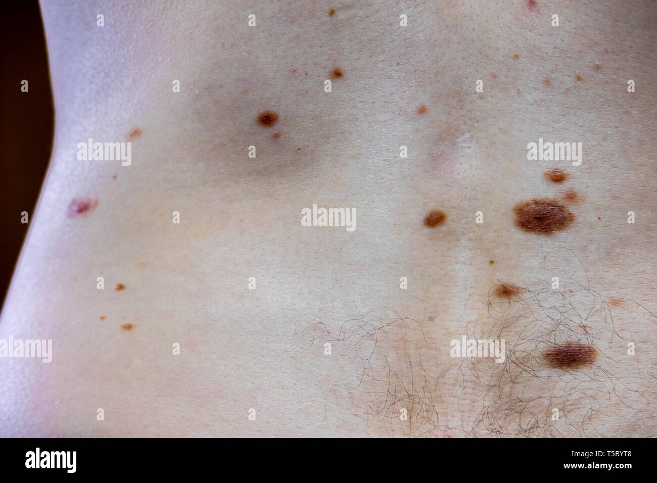 A melanocytic nevus also known as nevocytic , nevus-cell and commonly ...