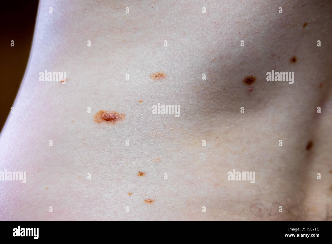 A melanocytic nevus also known as nevocytic , nevus-cell and commonly ...