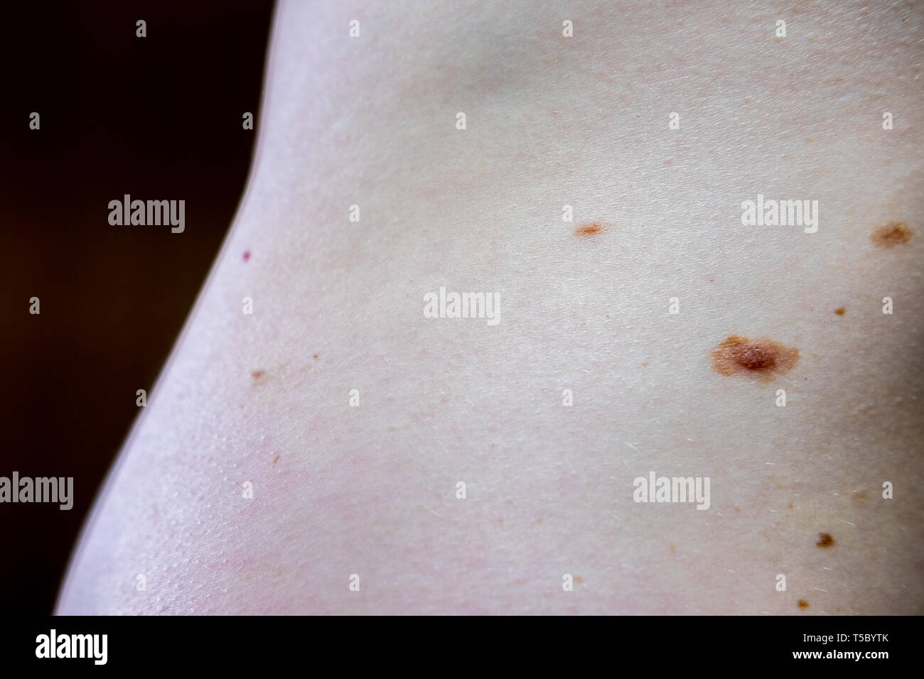 A melanocytic nevus also known as nevocytic , nevus-cell and commonly ...