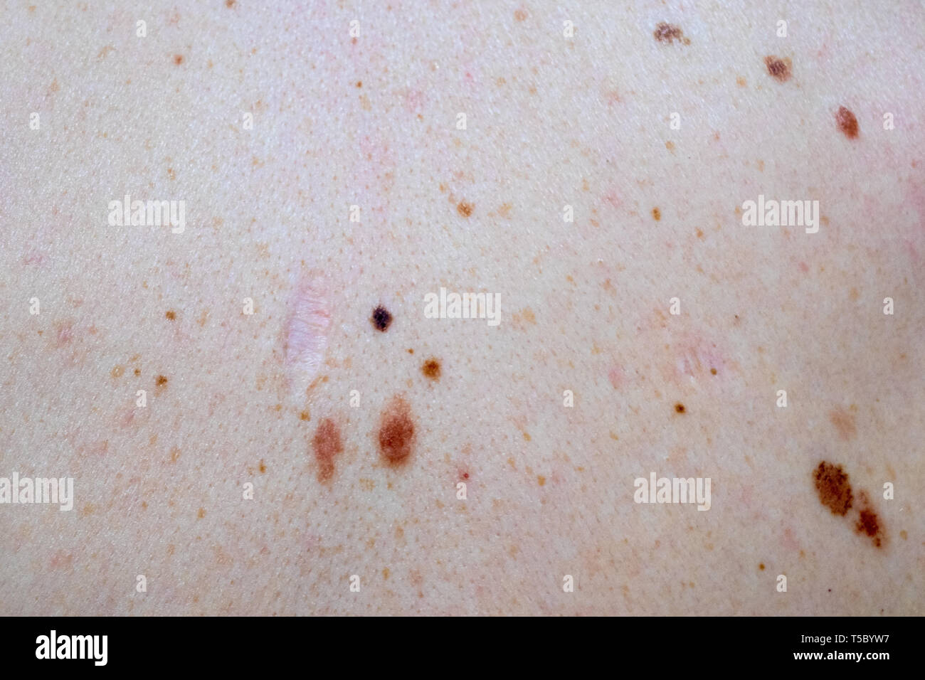 A melanocytic nevus also known as nevocytic , nevus-cell and commonly ...