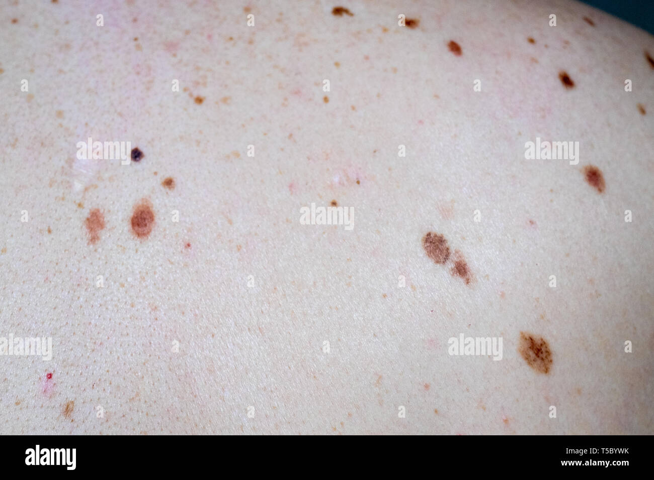 A melanocytic nevus also known as nevocytic , nevus-cell and commonly ...