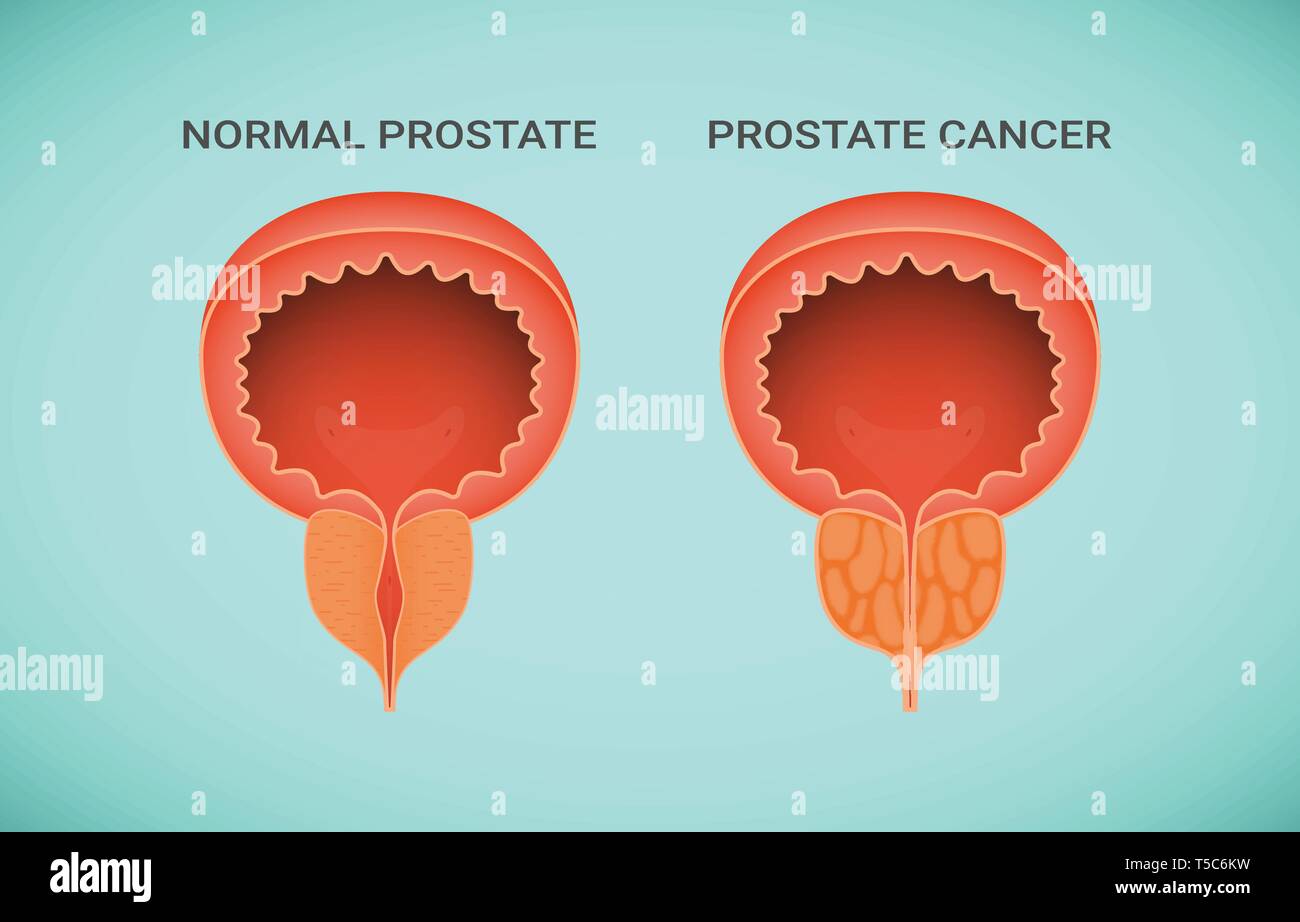 Comparison of Healthy and Cancer Prostate illustration Stock Vector ...