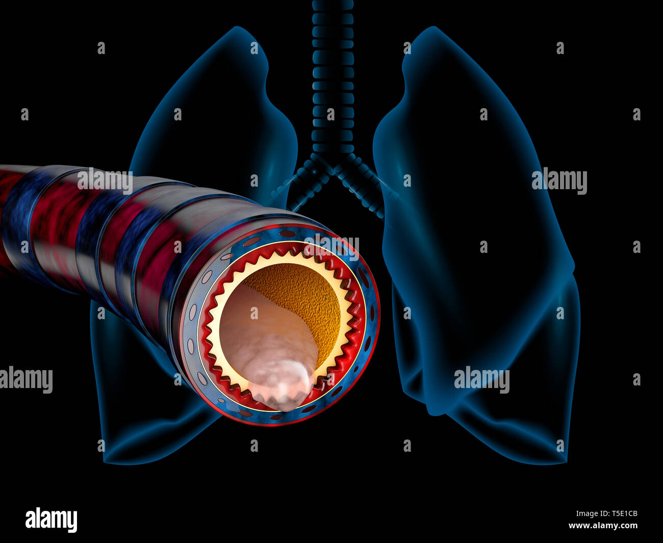 Bronchitis anatomy, mucus secreted as a chest cold as a 3D illustration ...