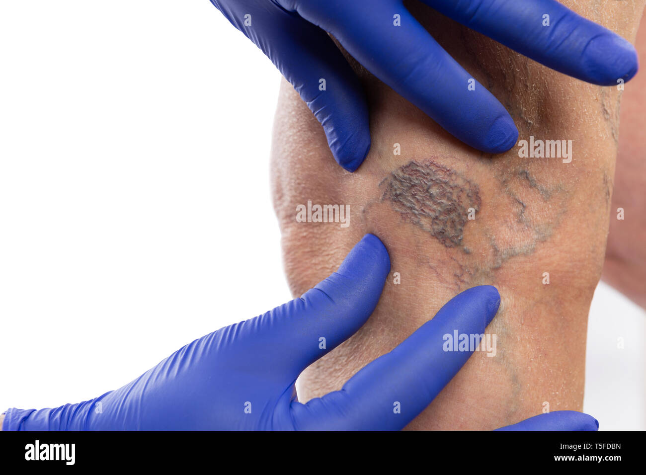 Medic with latex surgical gloves touching varicose veins on leg of ...