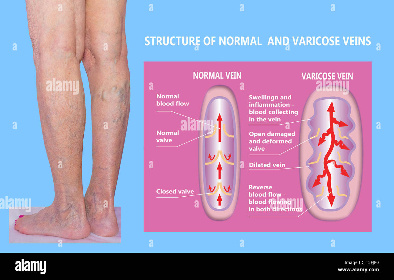 Varicose veins on a female senior legs. The structure of normal and ...
