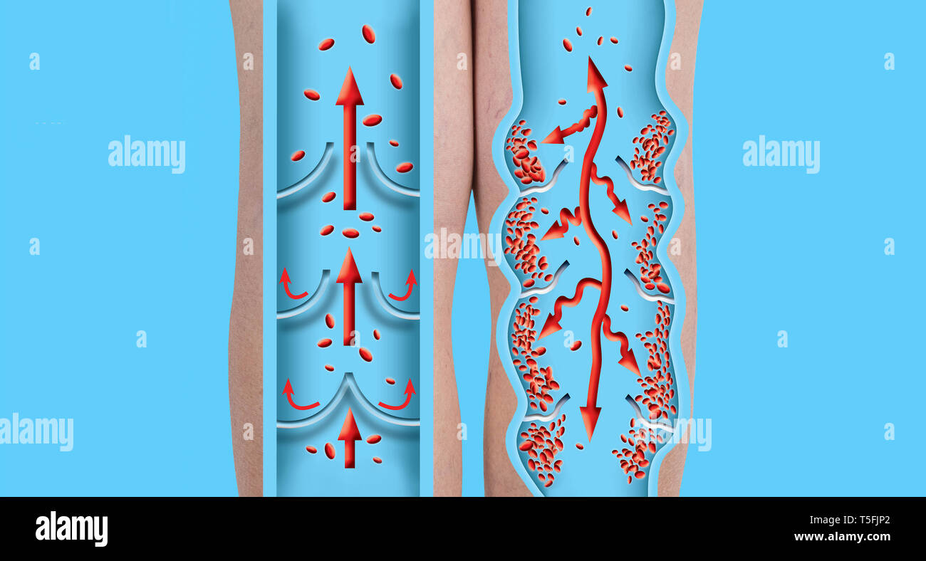 Dvt leg hi-res stock photography and images - Alamy