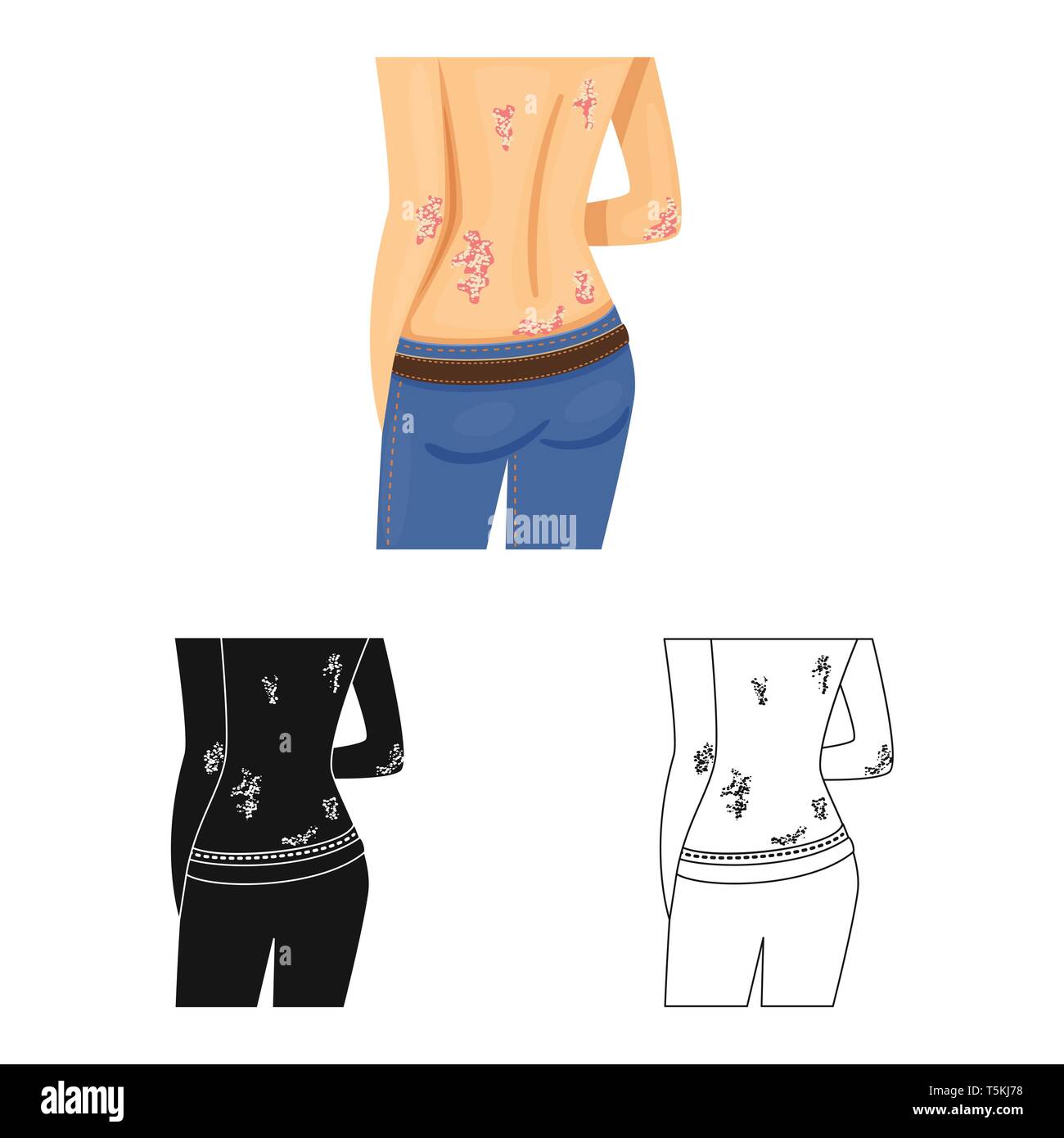 allergy,stress,itchy,rash,girl,back,psoriasis,skin,body,eczema,medical ...