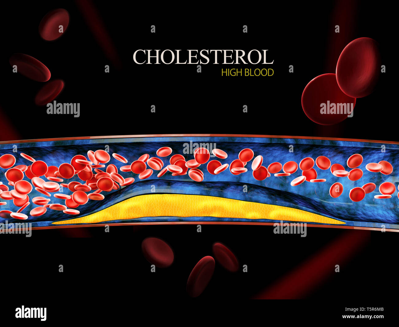 3d Illustration of blood cells with plaque buildup of cholesterol Stock ...