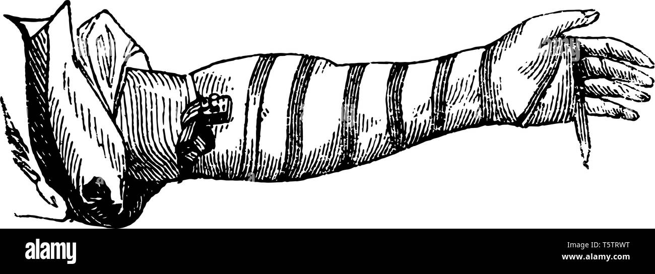 A wrapped Arm has a hand images, vintage line drawing or engraving ...