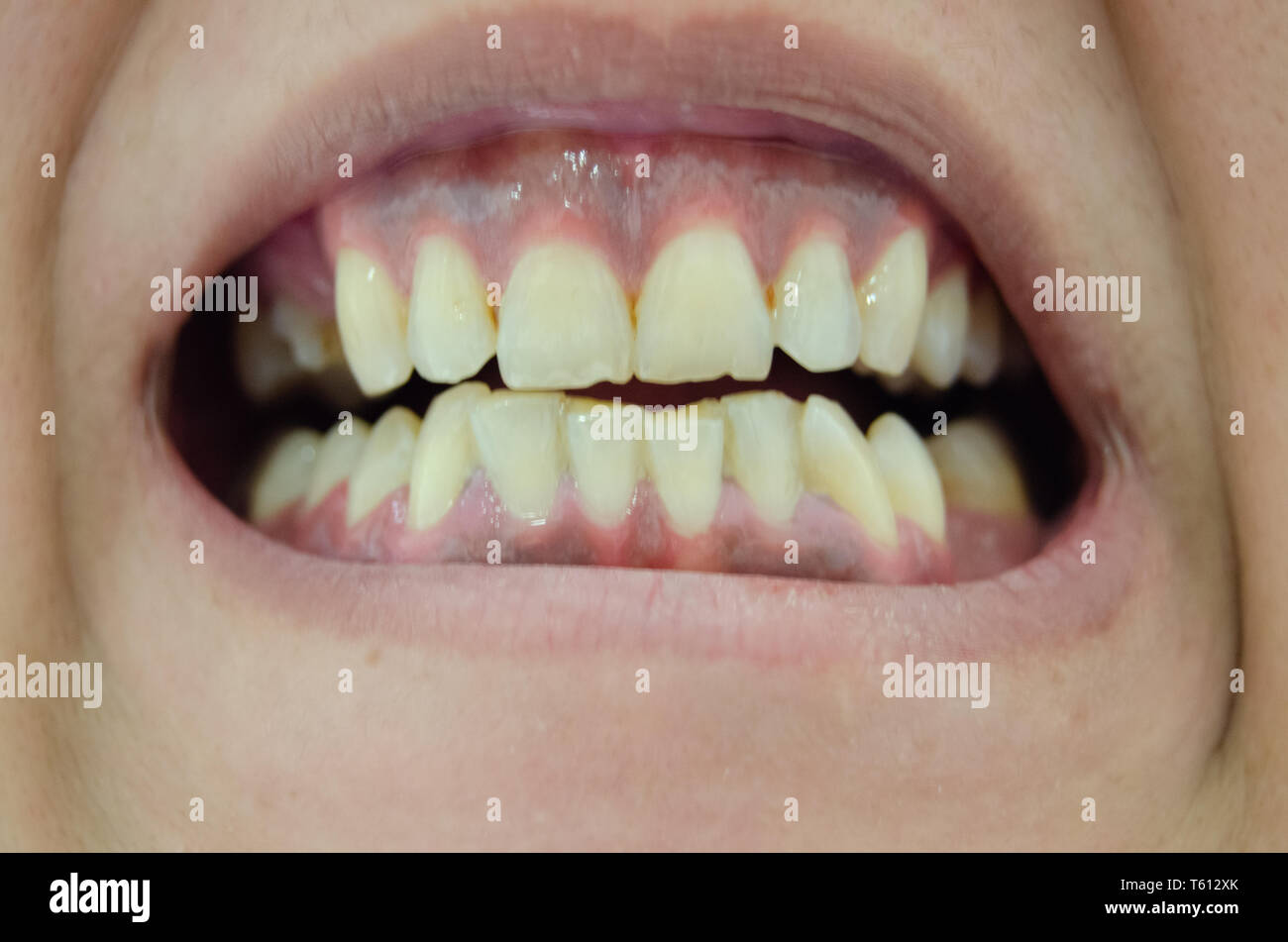 Dirty Teeth High Resolution Stock Photography and Images - Alamy