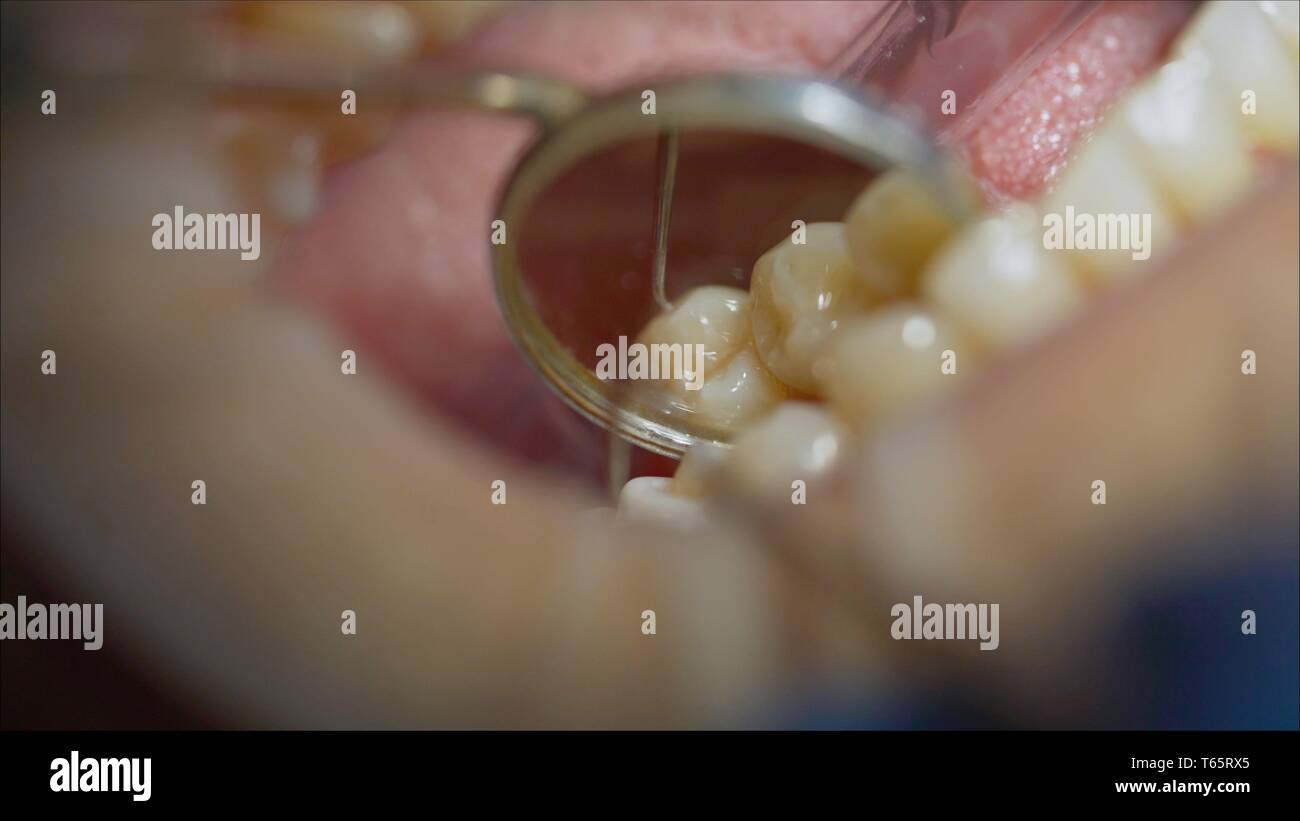 Dentist examining a patient's teeth in the dentist. Examination of the ...