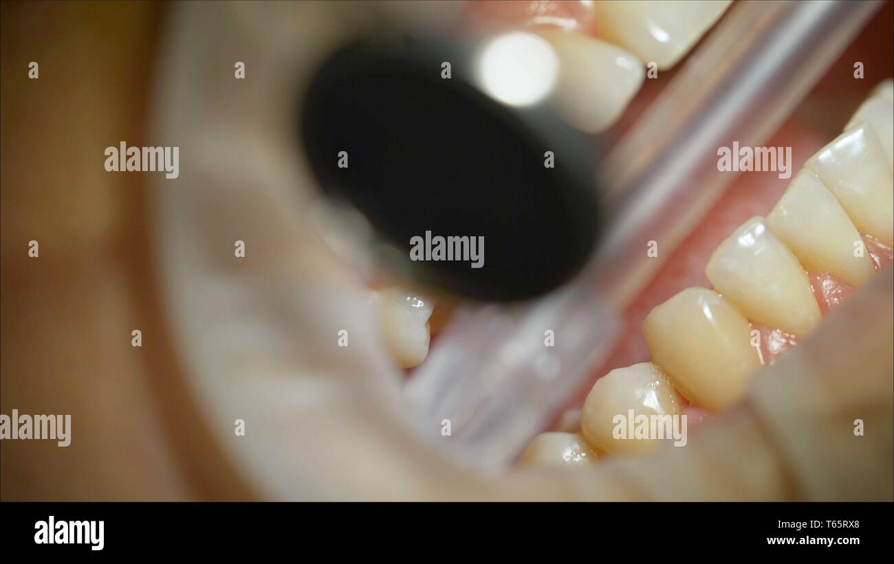 Dentist examining a patient's teeth in the dentist. Examination of the ...