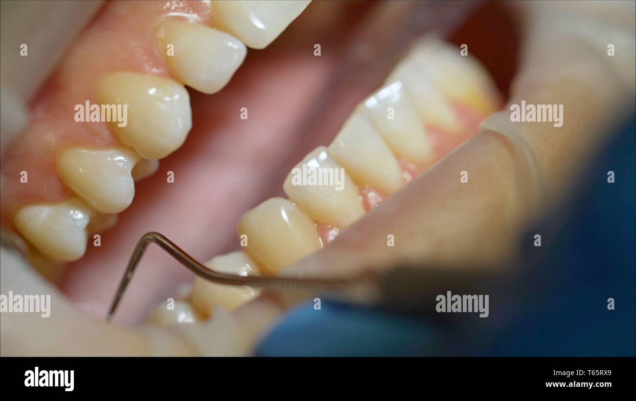 Dentist examining a patient's teeth in the dentist. Examination of the ...