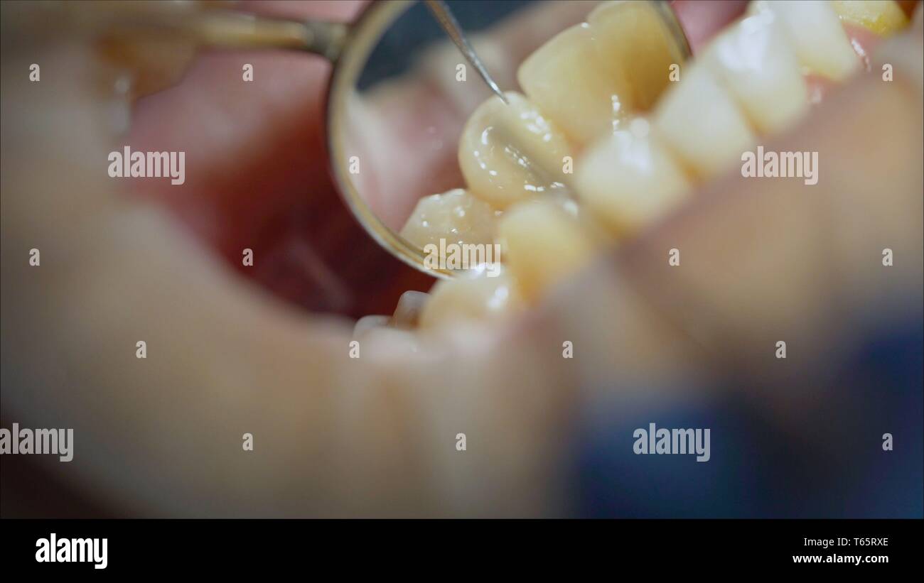 Dentist examining a patient's teeth in the dentist. Examination of the ...