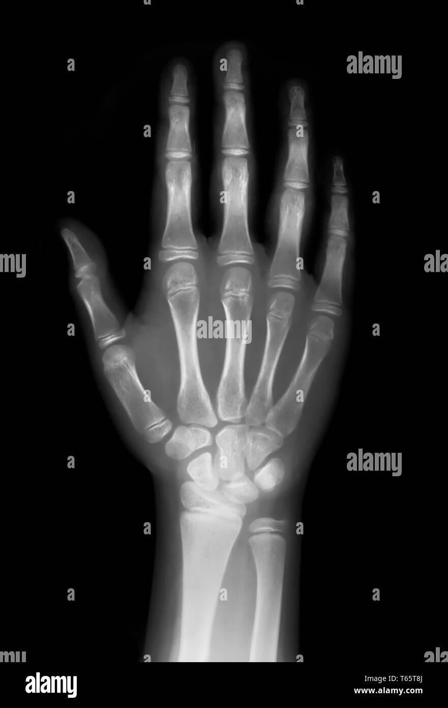 Raise Your Right Hand X Ray Chest Radiograph