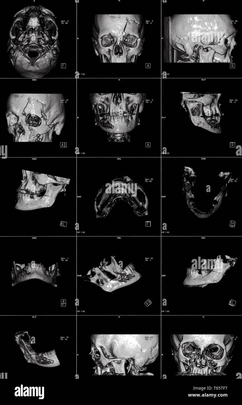 MRI of head Stock Photo - Alamy