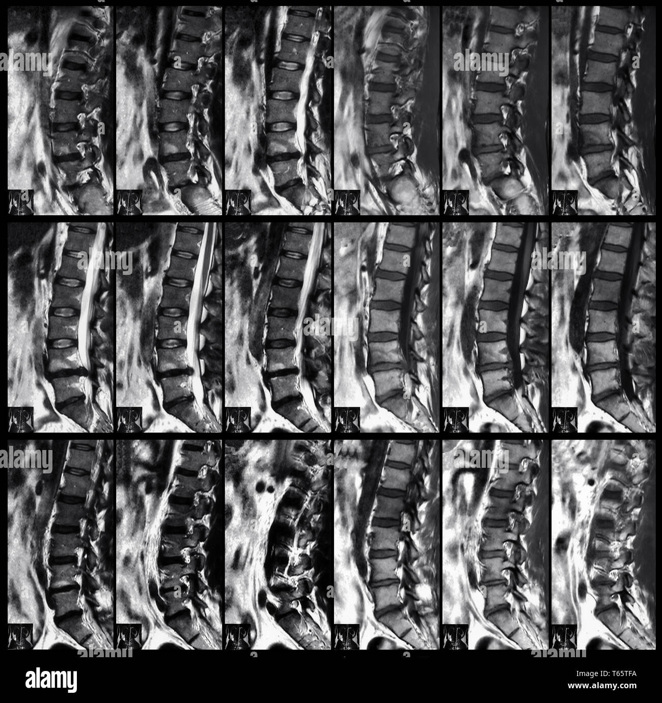Xray of lumbar spine hi-res stock photography and images - Alamy